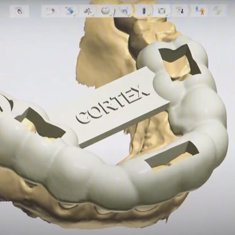 digital implant Work Flow | Case Studies | Cortex - Dental