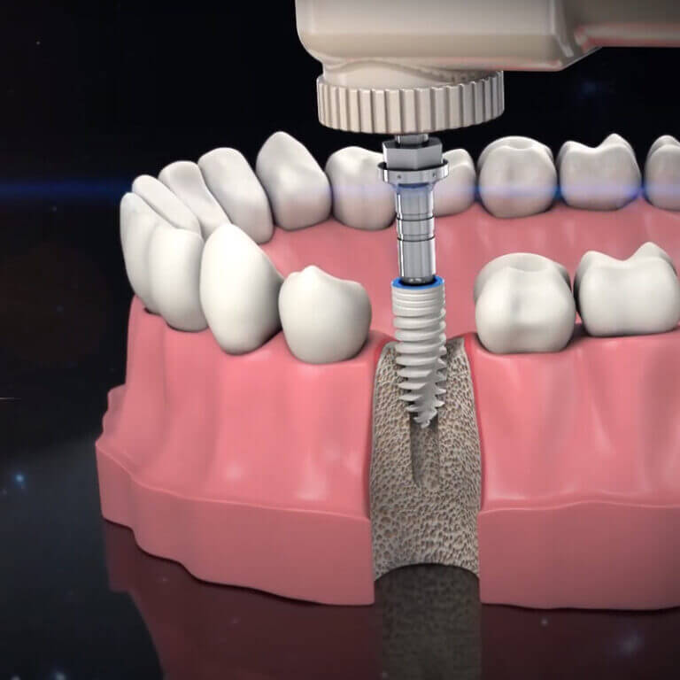 Tooth Drilling Procedures | Case Studies | Cortex - Dental